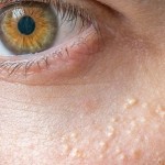 Skąd się biorą prosaki? Domowe i profesjonalne sposoby na prosaki